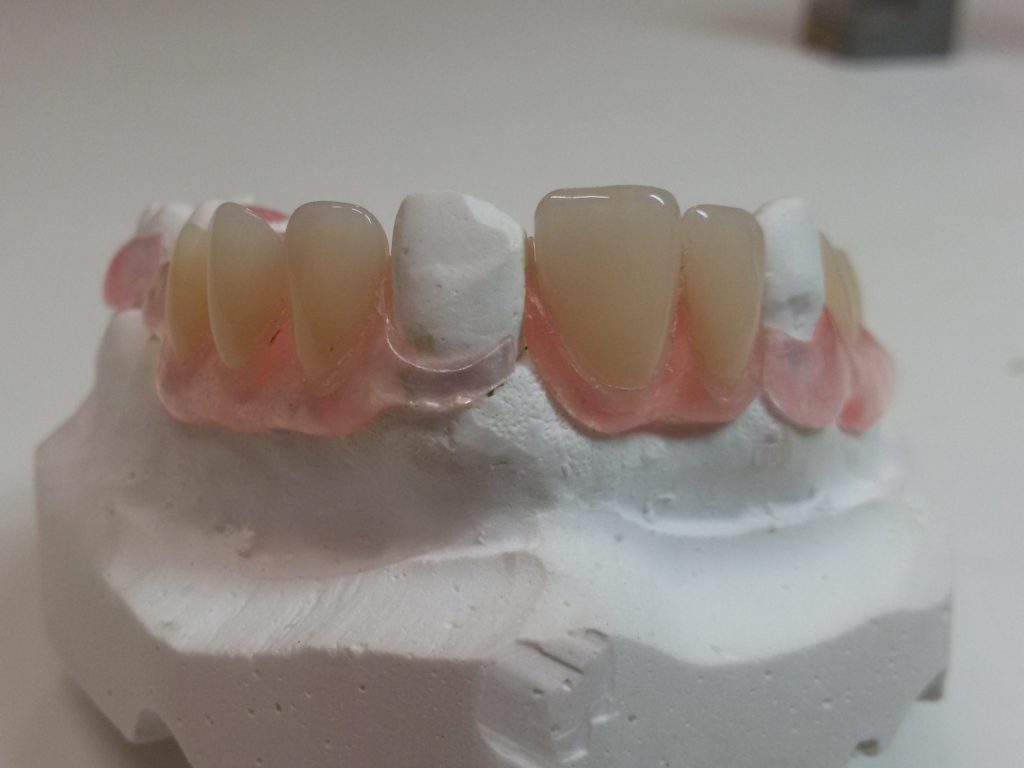 Protesi rimovibile flessibile in Nylon 📍 | 3D Lab